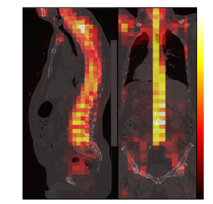 Attention-Driven Deep Learning for Pathological Spine Segmentation-CSDN博客